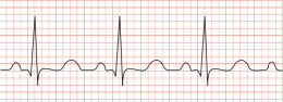 ACLS Tachycardia Algorithm - Heart Start CPR