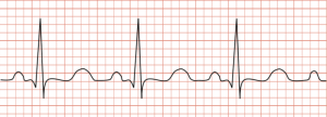ACLS Tachycardia Algorithm - Heart Start CPR