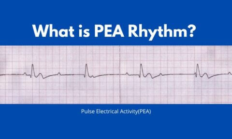 What Is PEA Rhythm? Causes, ECG Signs & ACLS Guide