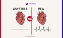 Asystole vs PEA: Key Differences in Cardiac Arrest Rhythms